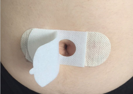 Medicina ACElok dressing