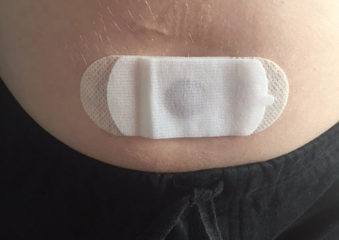 Medicina ACElok dressing